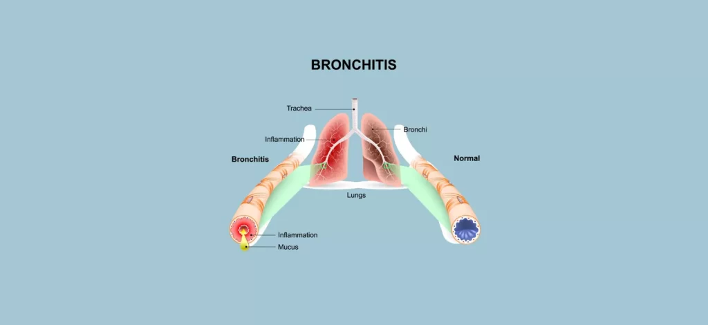 Bronşit Nedir? - Sağlık Tavsiyesi
